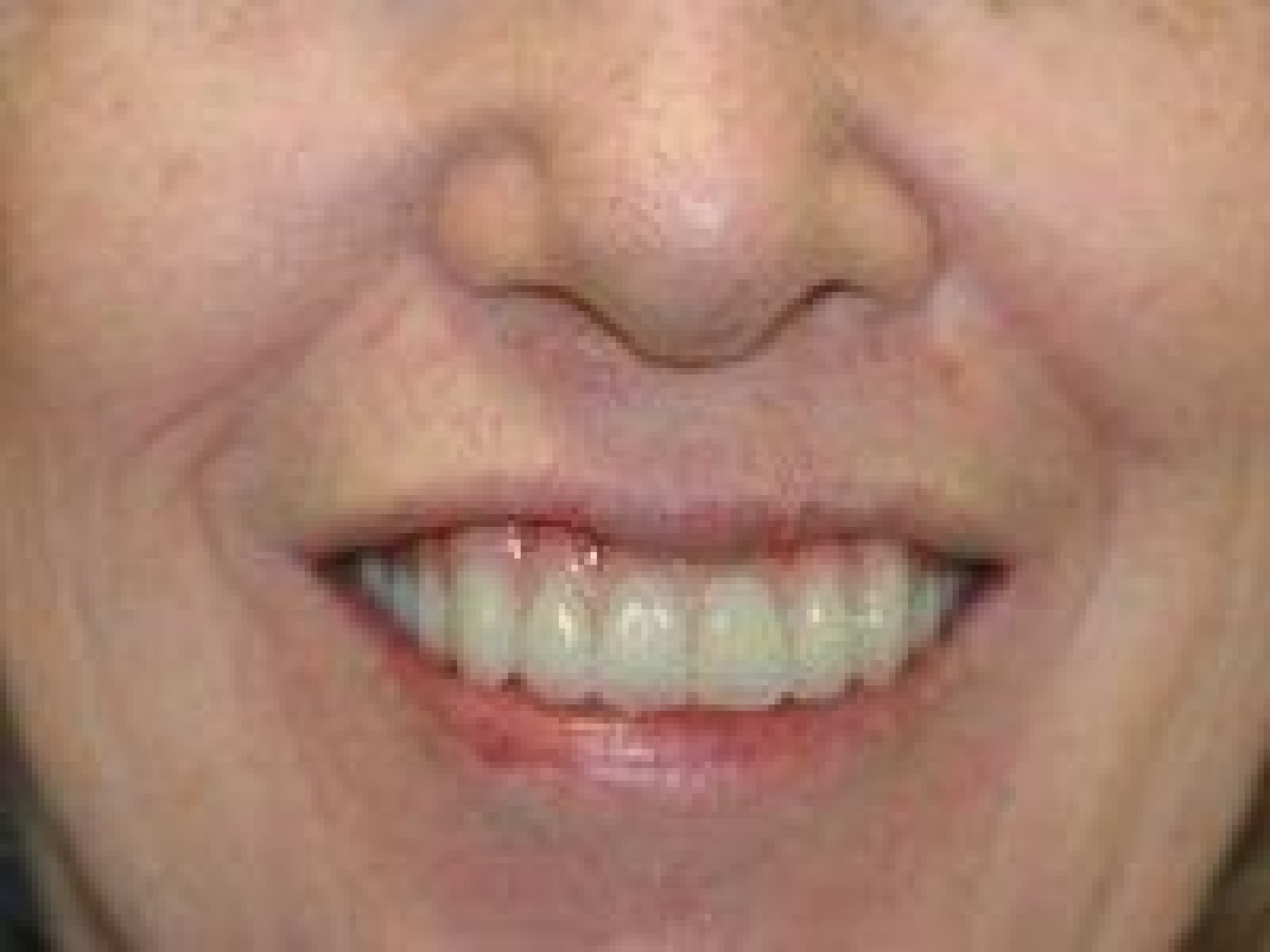 Smile Design | Classic Denture Studio | Dental Implants & Dental Prosthesis